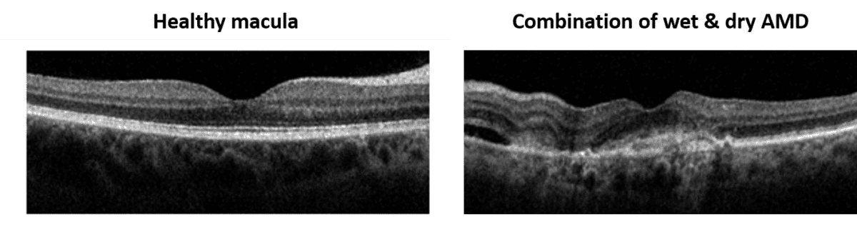 The Big 3: Cataracts + Glaucoma + Macular Degeneration